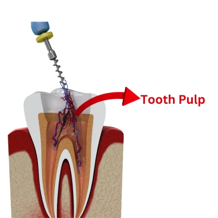 Affordable Root Canal Pulp Removal