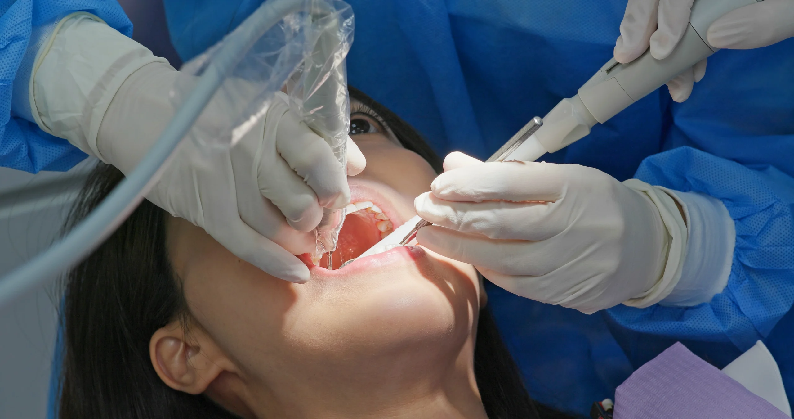 Tooth Extraction Frisco | Active Dental Frisco